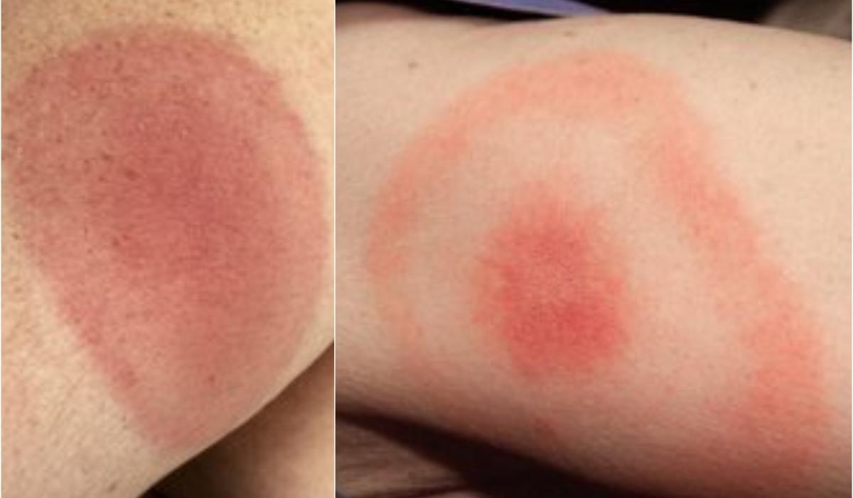 HSE warning as they share pictures of odd rash that could signal deadly infection - Tipperary Live